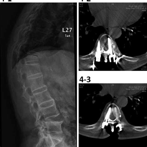 Intraoperative Spinal CT Scan Shows A Fracture Distraction And Download Scientific