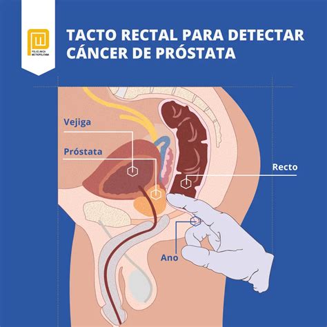 Causas Del Cáncer De Próstata Un Análisis Completo Doctor Online