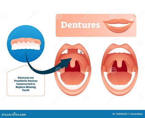Oral Mouth Ulcers Canker Sores Internal Organs Anatomy Body Part