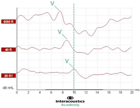 What Is Auditory Brainstem Response Abr Testing Interacoustics