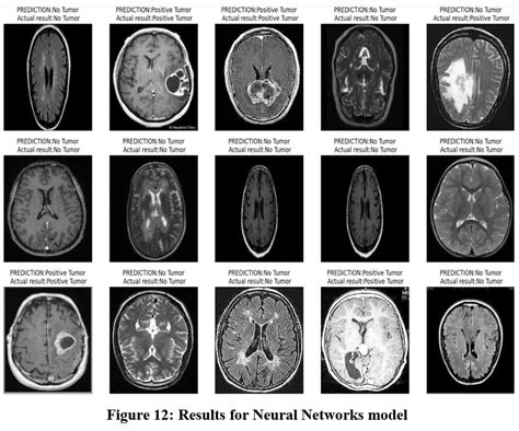 Automated Brain Tumor Detection With Advanced Machine Learning