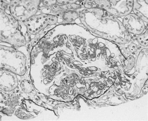 A Pre Treatment Renal Biopsy Specimen Of The Patient Showing Download Scientific Diagram