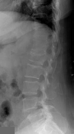 Normal Bone Metabolism Basic Science Orthobullets