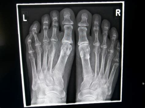 Rheumatologe Rheumatoid Arthritis Radiographic Progression