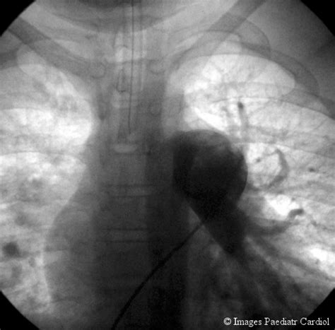 An Nih Catheter Was Placed In The Mpa And An Angiogram Performed