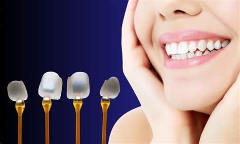 Exploring Different Types Of Dental Veneers And Their Costs