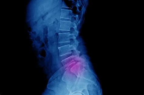 Komplikasi Berbahaya Yang Bisa Terjadi Akibat Leukopenia Komplikasi Berbahaya Yang Bisa Terjadi Akibat Leukopenia