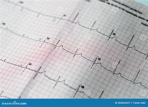 Ecg Electrocardiograph Paper That Shows Sinus Rhythm Abnormality Of