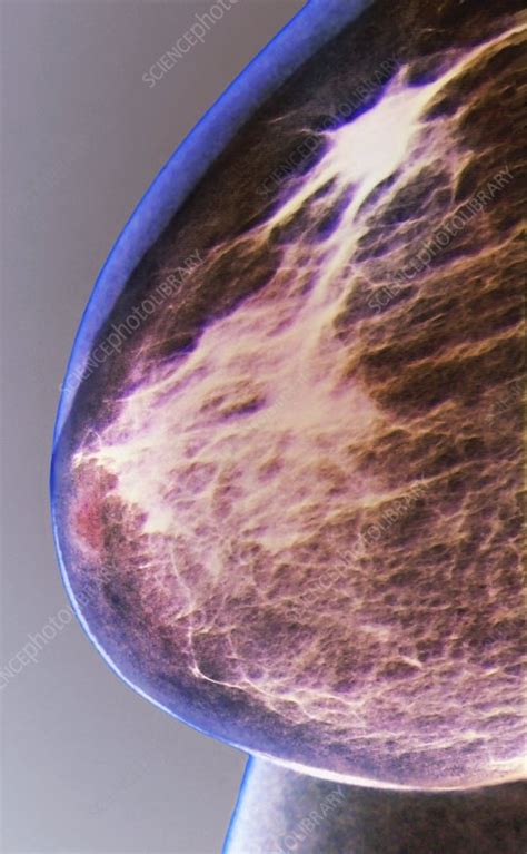 Breast Cancer X Ray Mammogram Stock Image C0095505 Science Photo Library