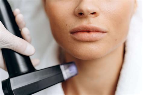 Morpheus 8 Side Effects Image Perfect Laser