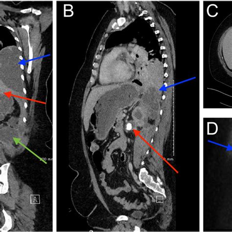 Pdf “uroptysis ” A Case Report Of Xanthogranulomatous Pyelonephritis With Nephrobronchial