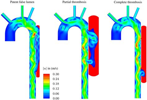 Representative Results From Cfd Analyses Showing Color Contours Of