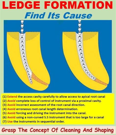 Ledge Formation Review Of A Great Challenge In Endodontics True