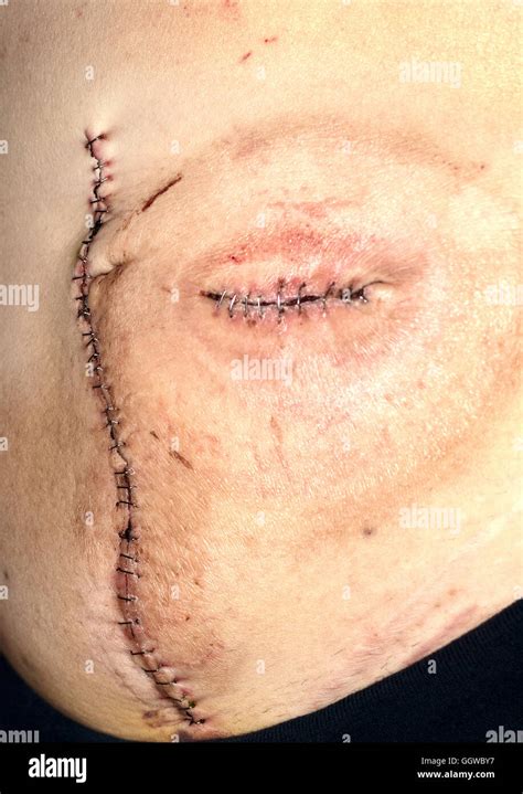 Scar And Stapled Suctures From A Closure Enterostomy Large And Small