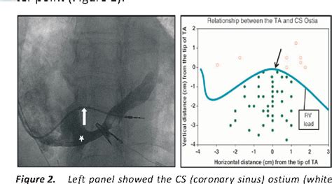 Figure 2 From An Overview Of Current Cardiac Resynchronization Therapy Semantic Scholar
