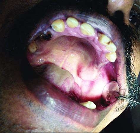 Maxillary Tuberosity Enlargement Cause At Sandra Wells Blog