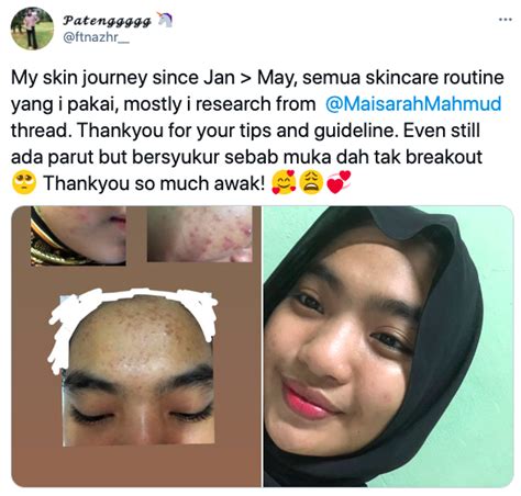 Lepas 5 Bulan Pulih Dari Breakout Gadis Ini Kongsi Rutin And Produk
