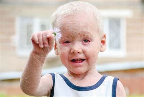 იქთიოზი ბავშვებთან რატომ სქელდება კანის რქოვანი შრე მკურნალი გე