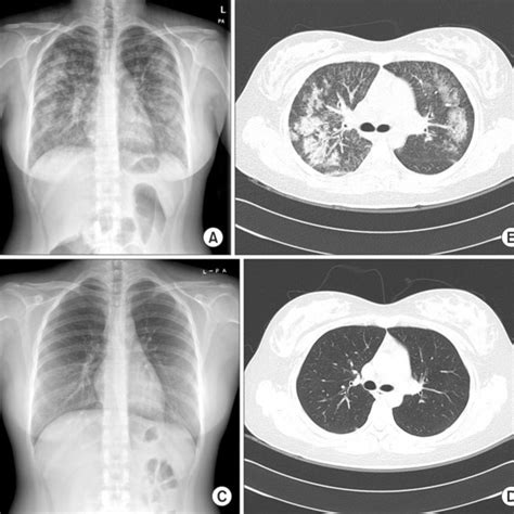 Chest Radiography And Computerized Tomography Ct Scan On Admission
