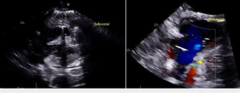 Bedside Tte V Urgent Transthoracic Bedside Echocardiogram Tte