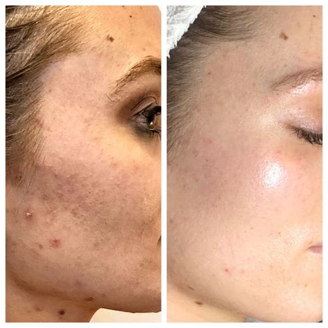 Classic Facial Refresh Your Skin Today Montreal
