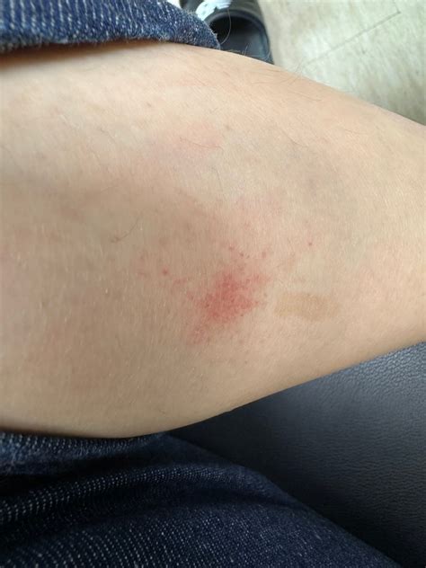 갑자기 빨개진 피부 지식in