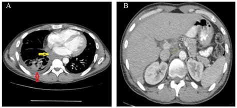 Chemotherapy And Immune Checkpoint Inhibitors In A Case Of Smarca4 Dut A Case Report And Review
