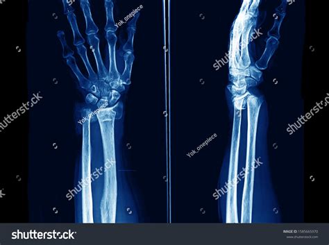 Styloid Process Of Radius