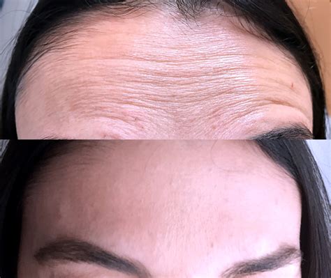 Before After Photos Wrinkle Line Reduction 4 NYC