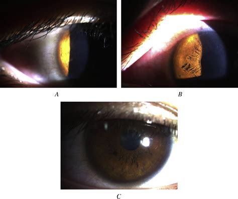 Table 1 From Diffuse Lamellar Keratitis After Femtosecond Laser