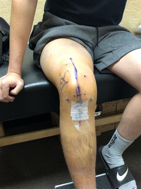 Acl Knee Injury Surgery Or Not Central Performance