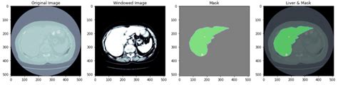 GitHub Najoua Zeffate Cancer Liver Detection This Project Aims To Detect Liver Cancer Using