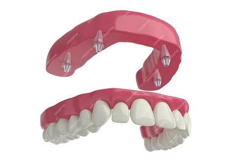 Premium Photo Dental Prosthesis 4 Overdenture Implants Upper Arch
