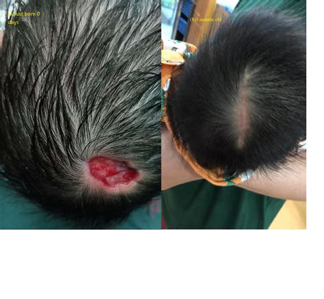 Isolated Aplasia Cutis Congenita Case Report Of Two Cases