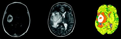 T1 T2 And The Segmented Image Of A Brain With A Tumor Download