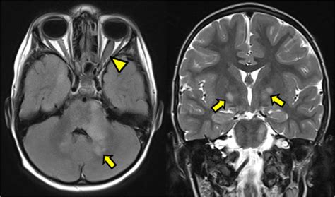 Axial Flair Sequence Left Side And Coronal T2 Weighted Tse Sequence