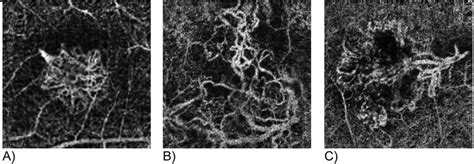 Cnv Types On Sd Octa A Dense Net Vascular Net With Branching