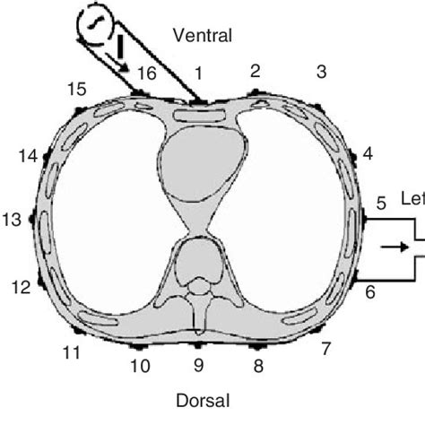 Characteristic Sawtooth Pattern Of The Expiratory Flow Signal Which