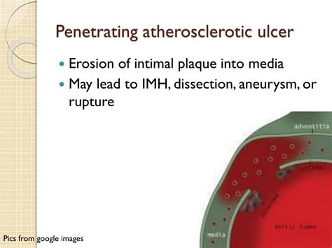 PPT Echocardiographic Evaluation Of Acute Aortic Syndromes PowerPoint Presentation ID 6651971