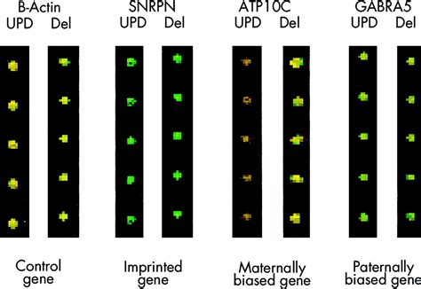 Microarray Analysis Of Gene Transcript Expression In Prader Willi