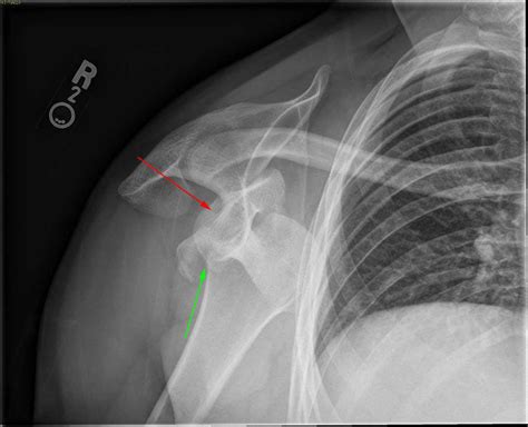 Pediatric Shoulder Dislocation X Ray At Fred Morales Blog