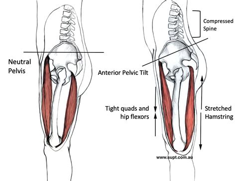 What Is An ‘anterior Pelvic Tilt And How To Correct It — Bodywork