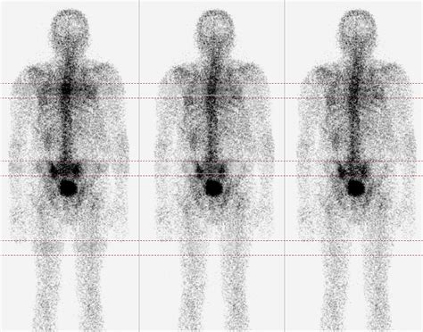 Mediso New Workflows And Algorithms Of Bone Scintigraphy Based On