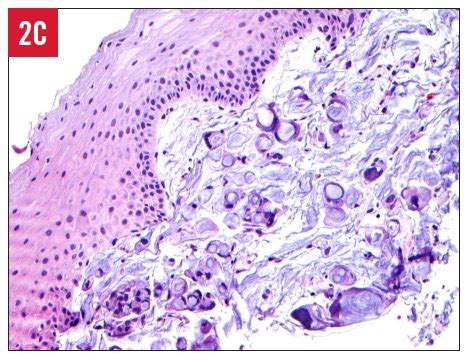 Gastric Signet Ring Cell Carcinoma With Bladder Metastasis Consultant