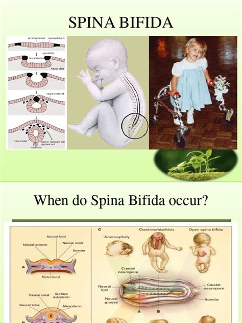 15 Spina Bifida Pdf Vertebral Column Neurological Disorders