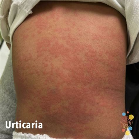 Urticaria Skin Deep