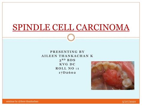 Spindle Cell Carcinoma Pptx Ear Nose And Throat Conditions Diseases And Conditions