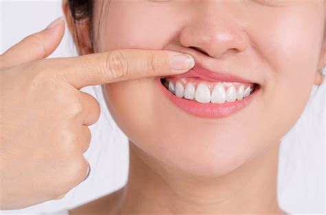 Gum Diseases Newlife Dental Practice