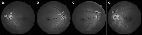 Optic Disc Tilt Was Identified Using The Ovality Index And The Tilt