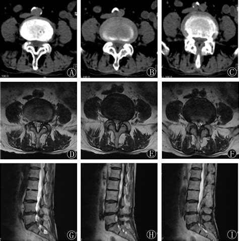 Percutaneous Endoscopic Unilateral Laminotomy And Bilateral